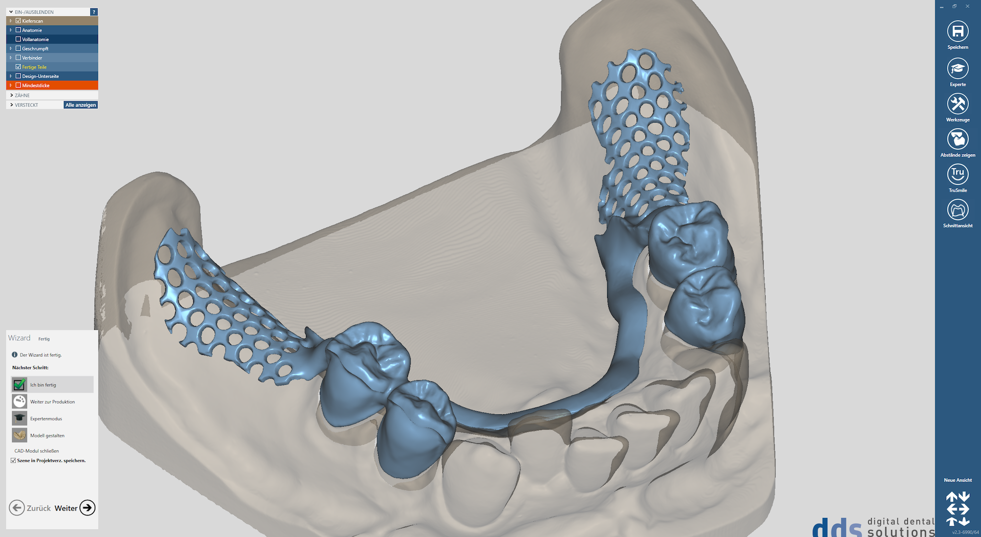 dds dentalCAD partialCAD module | digital dental solutions